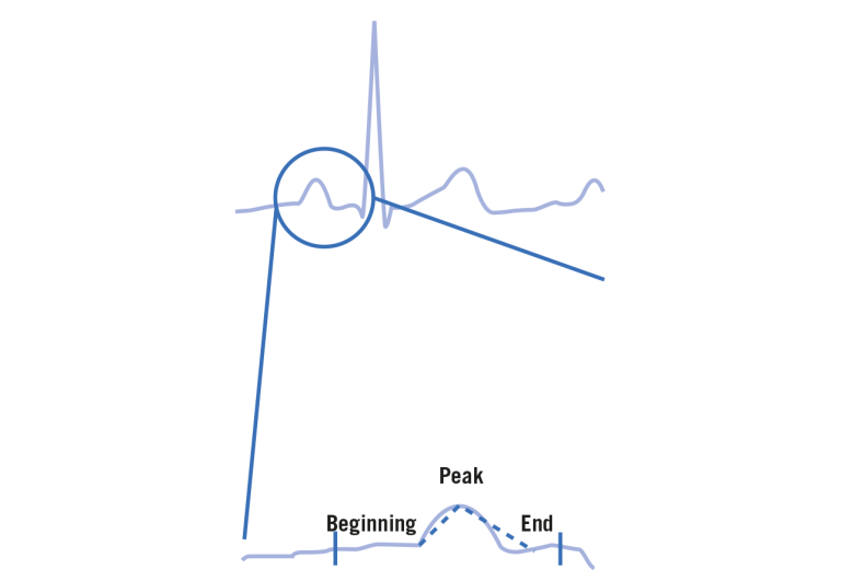 Atrial Fibrillation Detection For Patient Monitoring Clinical View
